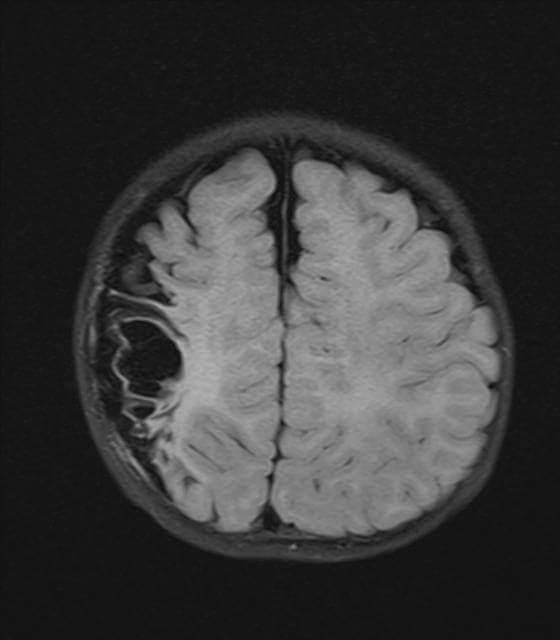 Young hemispherectomy patient Preston Natividad on road to recovery ...